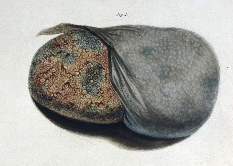 Richard Bright and the discovery of kidney disease – History of Nephrology